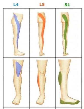 L4 L5 Dermatome Pain Explained — Nerve Root Compression & Chiropractor ...